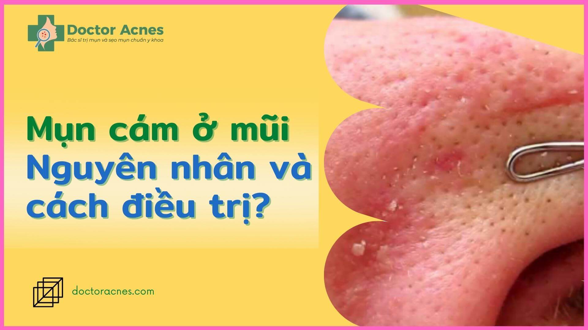 Mụn cám ở mũi: nguyên nhân và cách điều trị an toàn, hiệu quả