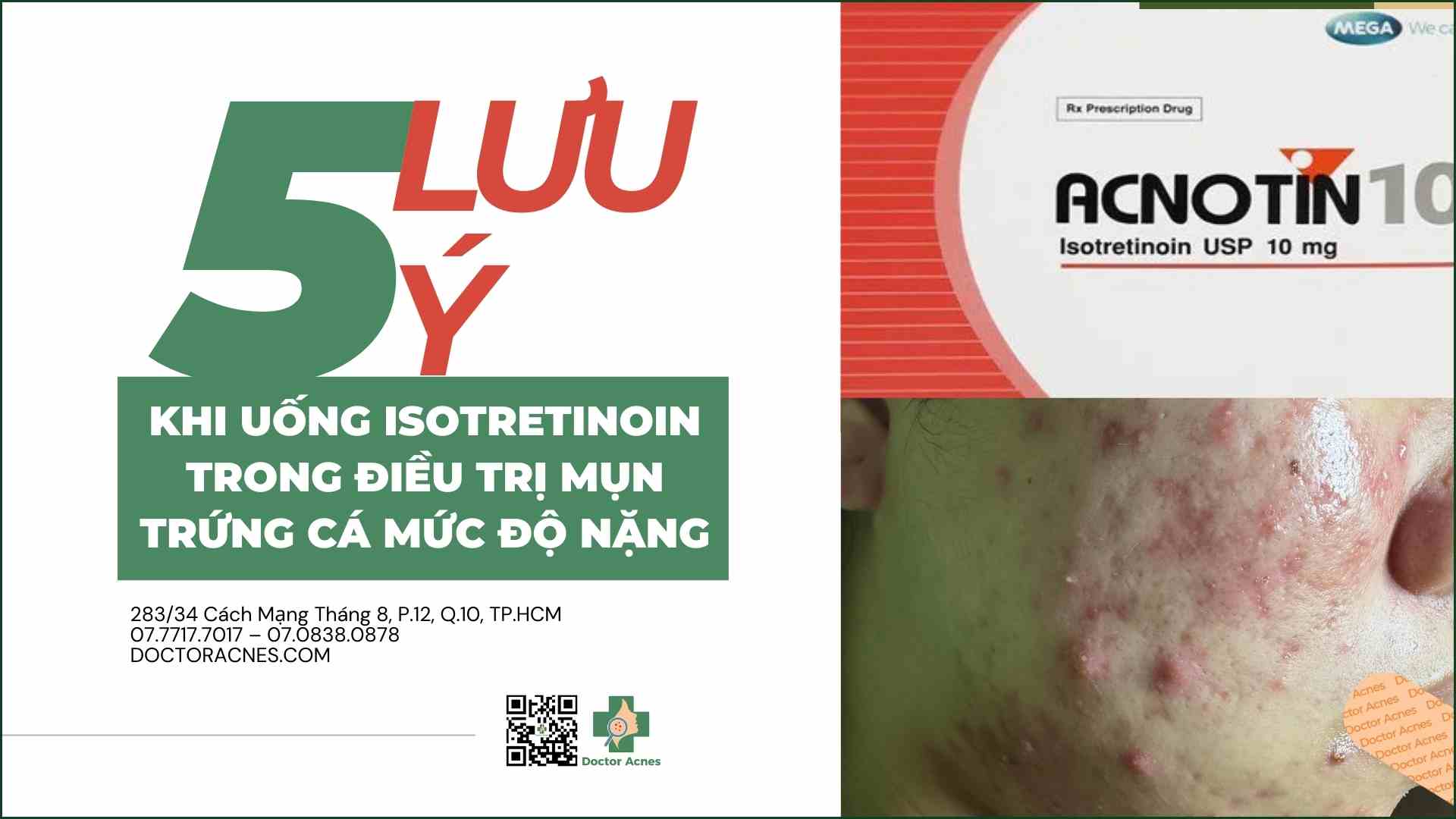 Trị mụn bằng isotretinoin và những lưu ý cần nắm rõ