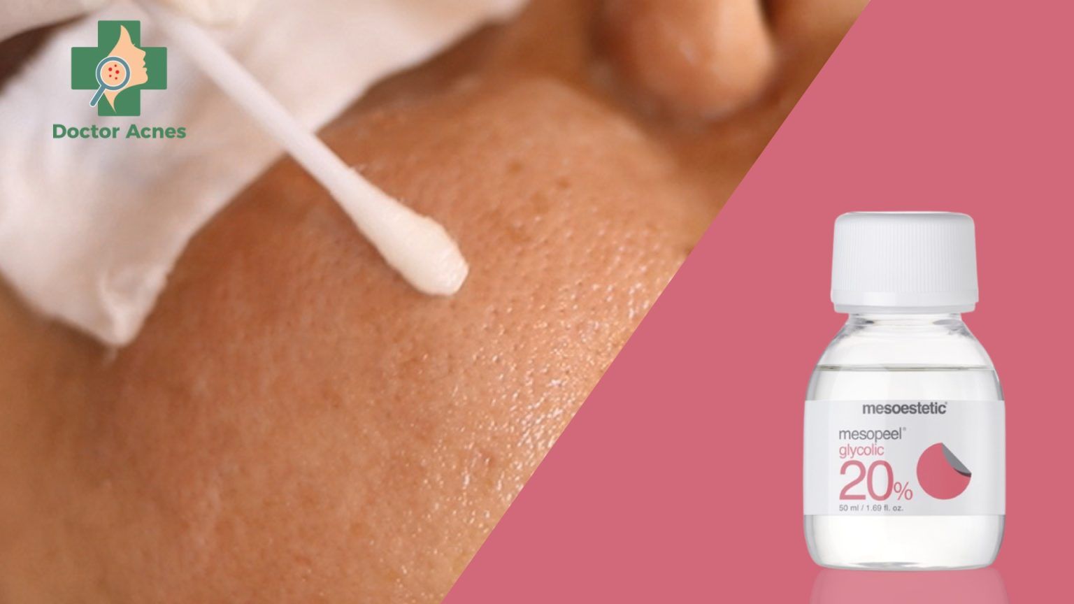 Peel da trị mụn giá bao nhiêu tiền tại Phòng Khám Doctor Acnes