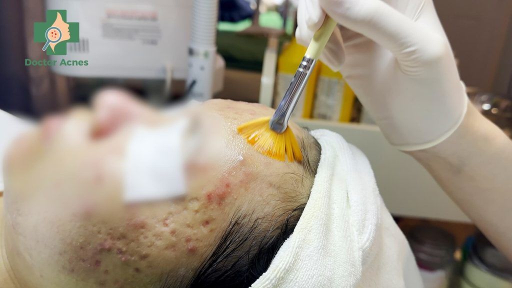 Peel da TCA là gì? Những điều cần biết về Peel da bằng TCA