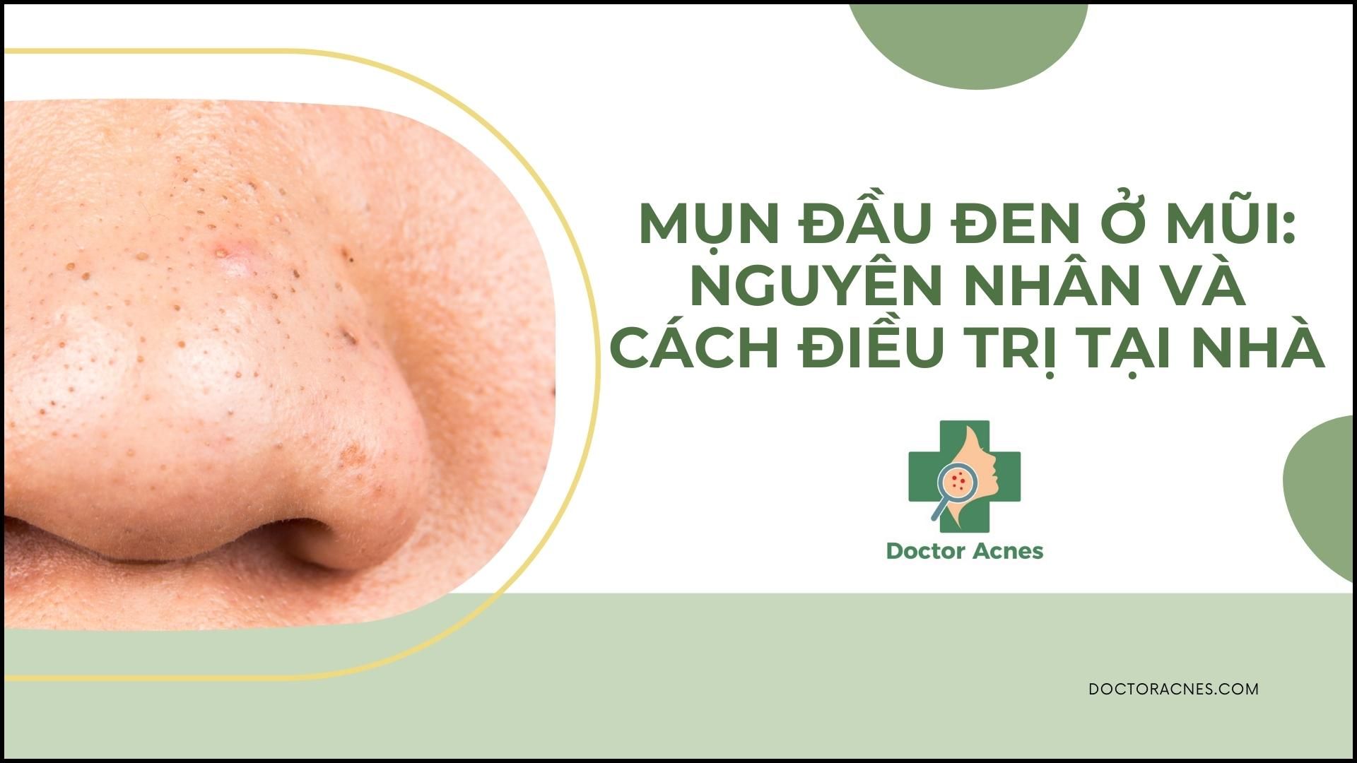 Mụn đầu đen ở mũi: nguyên nhân và cách điều trị tại nhà