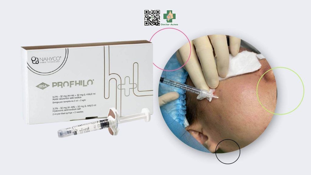 Tiêm BAP và tiêm meso khác nhau như thế nào?