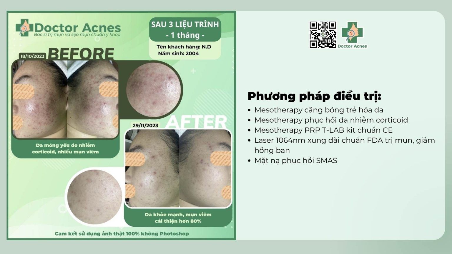 Huyết tương giàu tiểu cầu PRP phục hồi da tổn thương