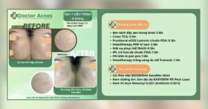 TCA là gì? Vai trò của TCA trong điều trị sẹo rỗ