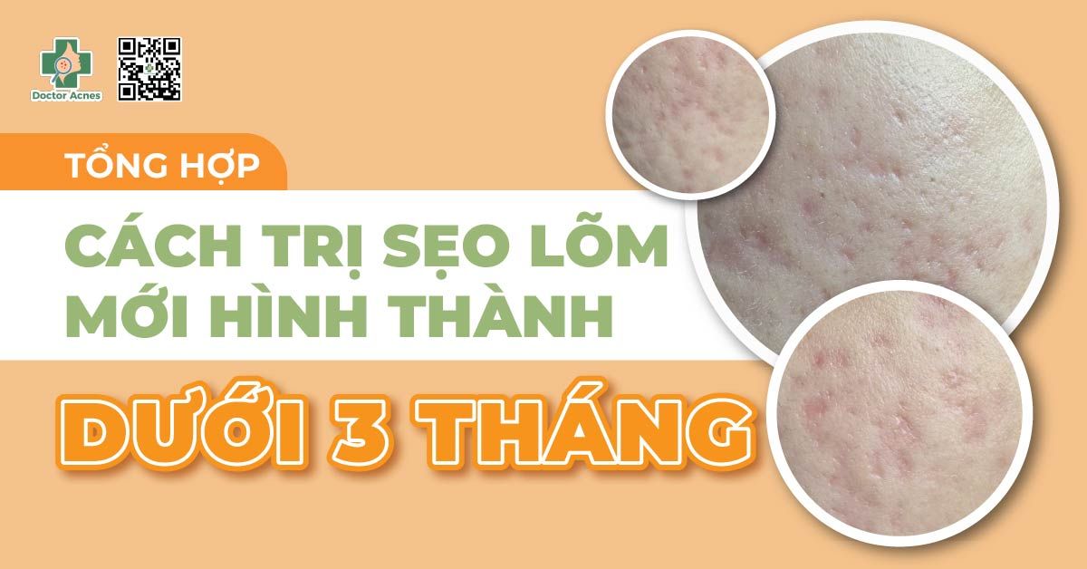 Các cách trị sẹo lõm mới hình thành theo Bác sĩ Da liễu