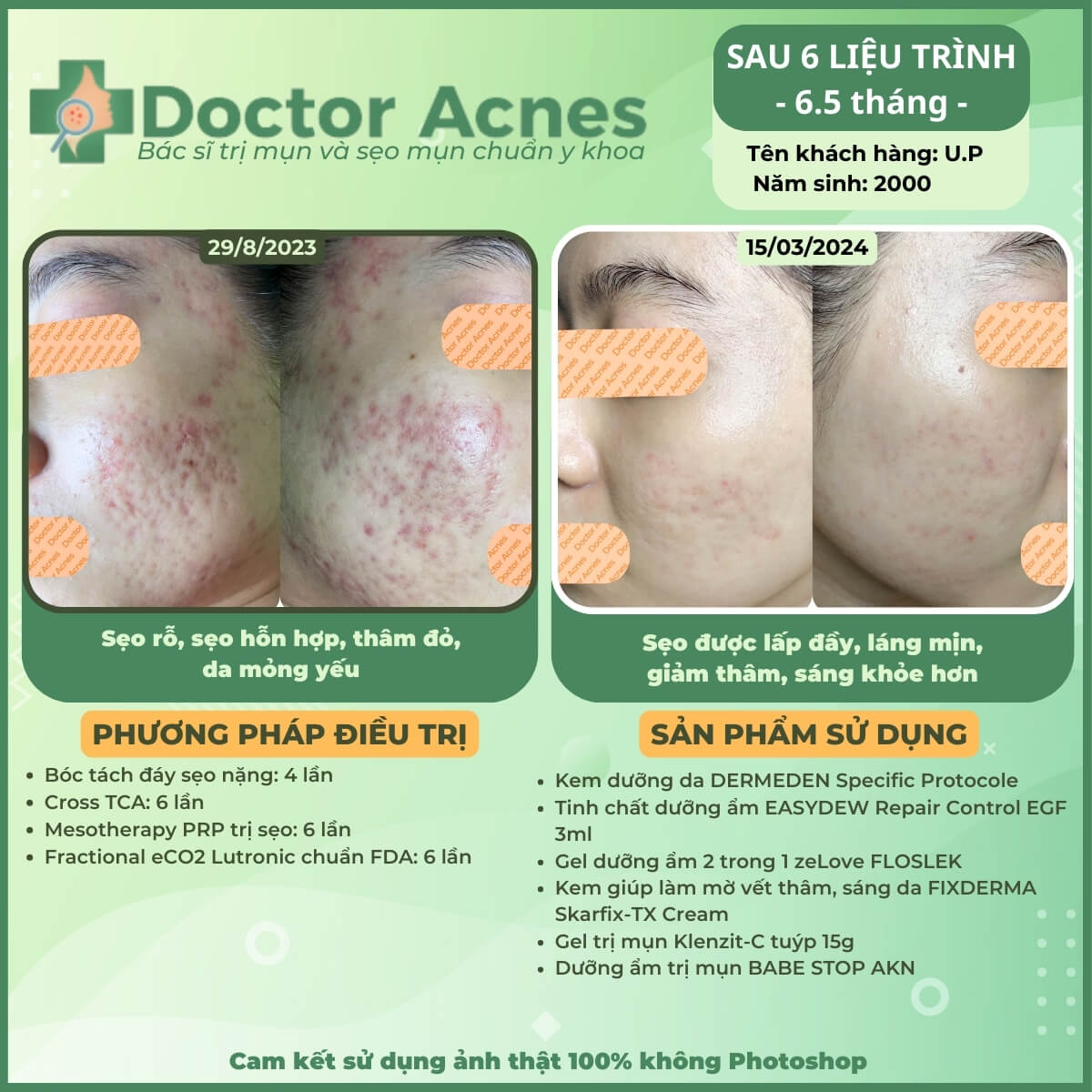 Trị sẹo rỗ bằng laser CO2 fractional giá bao nhiêu - Doctor Acnes