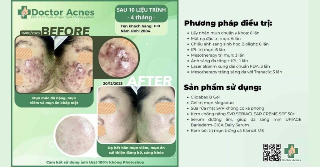 Nổi mụn ở chân mày: nguyên nhân, cách điều trị và phòng ngừa