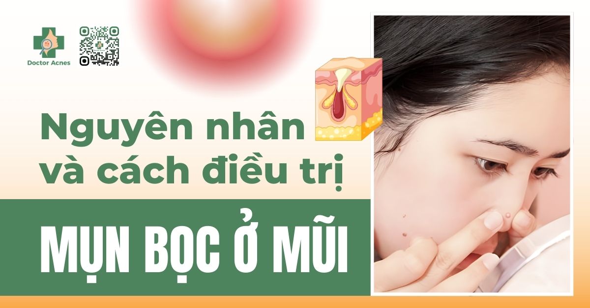 Mụn bọc ở mũi: Nguyên nhân và cách điều trị hiệu quả
