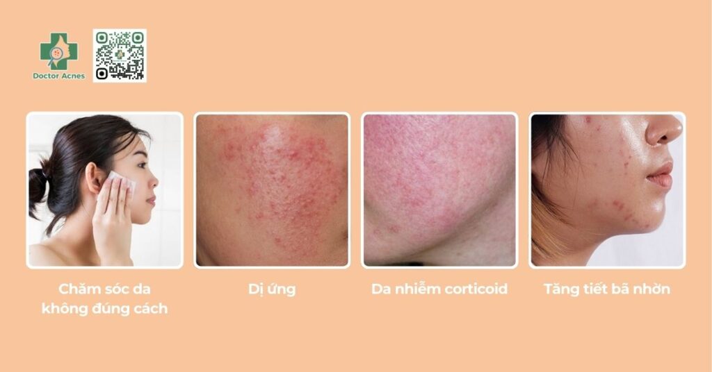 Các loại mụn li ti thường gặp và cách xử lý tốt nhất