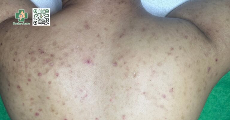 Da lưng bị sạm đen: nguyên nhân và cách điều trị