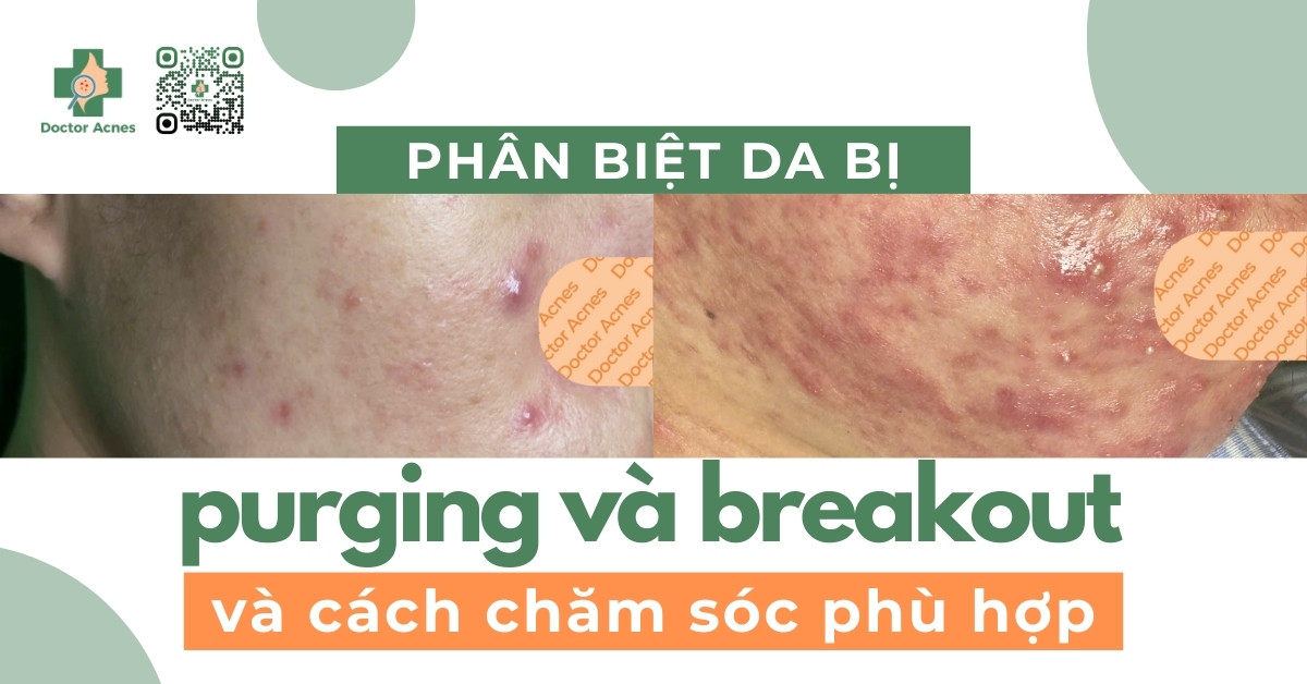 Phân biệt da bị purging và break out và cách xử lý hiệu quả
