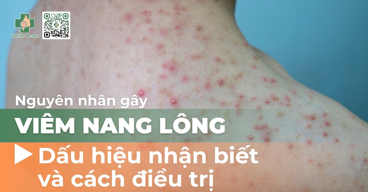 Viêm nang lông: dấu hiệu, cách điều trị và phòng ngừa