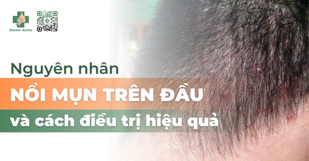 Mọc mụn trong mũi: nguyên nhân và phương pháp điều trị