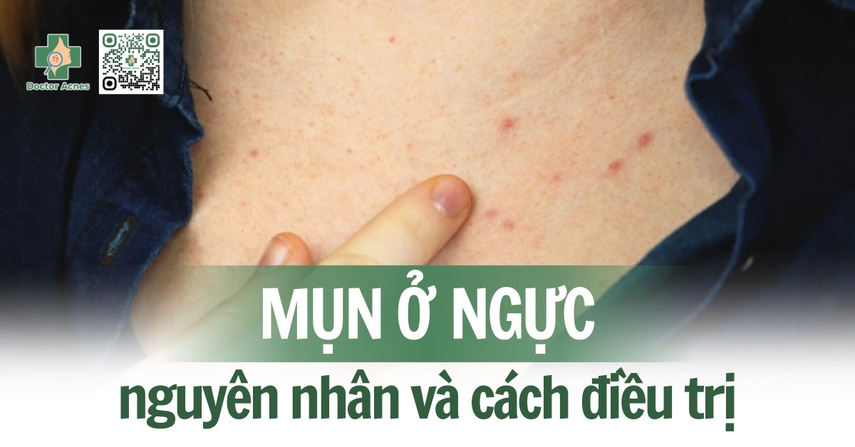 Mụn mọc quanh miệng: nguyên nhân và cách điều trị