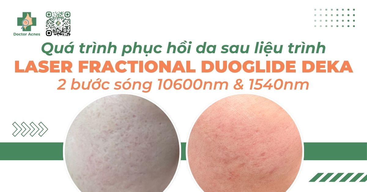 Quá trình phục hồi da sau liệu trình Deka Duoglide
