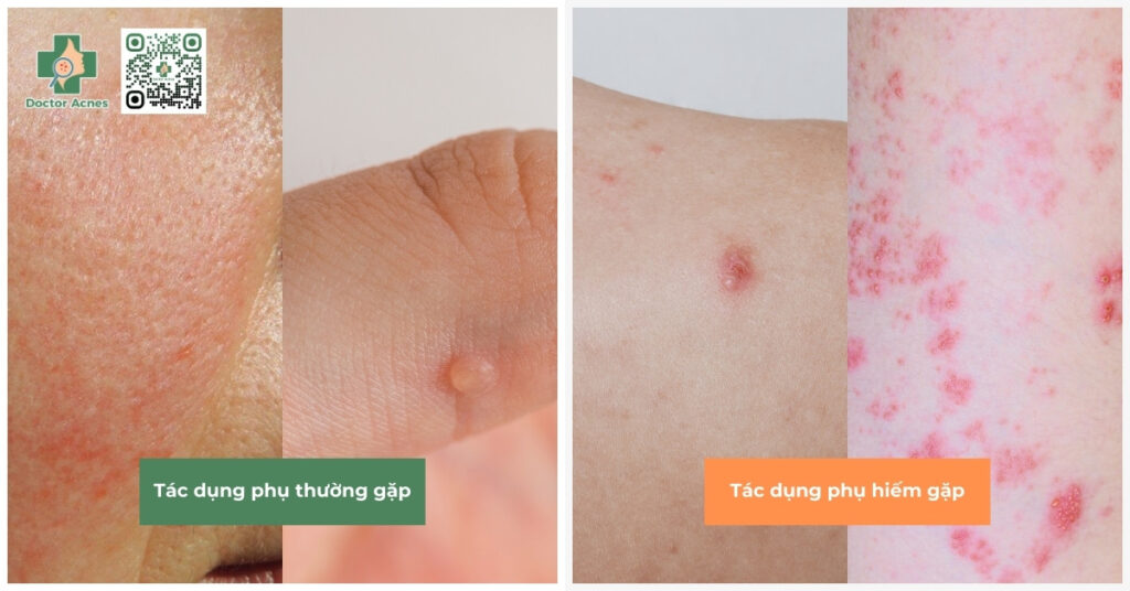 Hydrogen peroxide là gì? Cách sử dụng H2O2 trong trị mụn