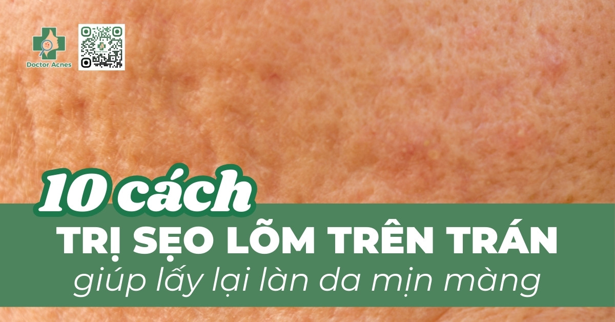 10 cách trị sẹo lõm trên trán giúp lấy lại làn da mịn màng