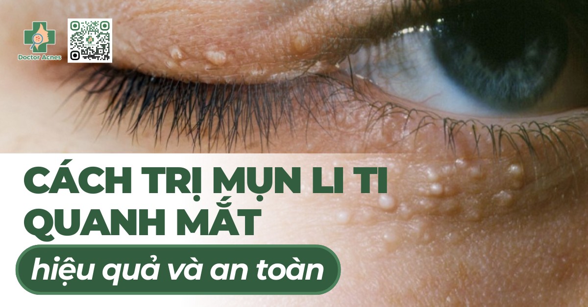 Cách trị mụn li ti quanh mắt hiệu quả và an toàn