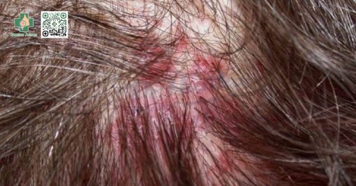 Mụn ở chân tóc: nguyên nhân và cách điều trị hiệu quả