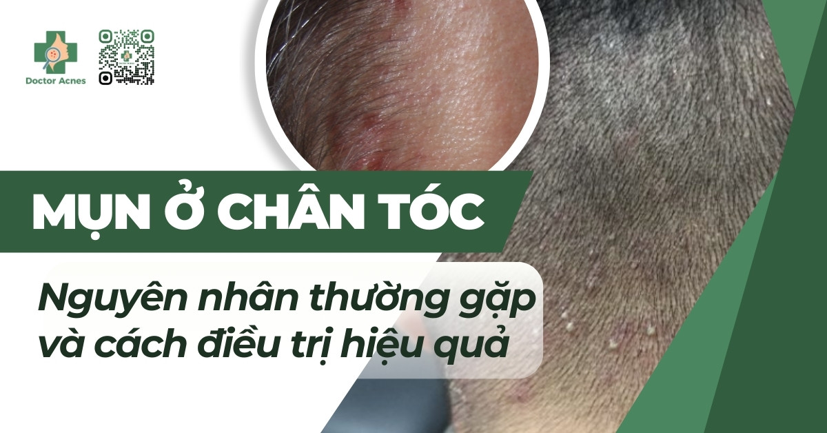 Mụn ở chân tóc: nguyên nhân và cách điều trị hiệu quả